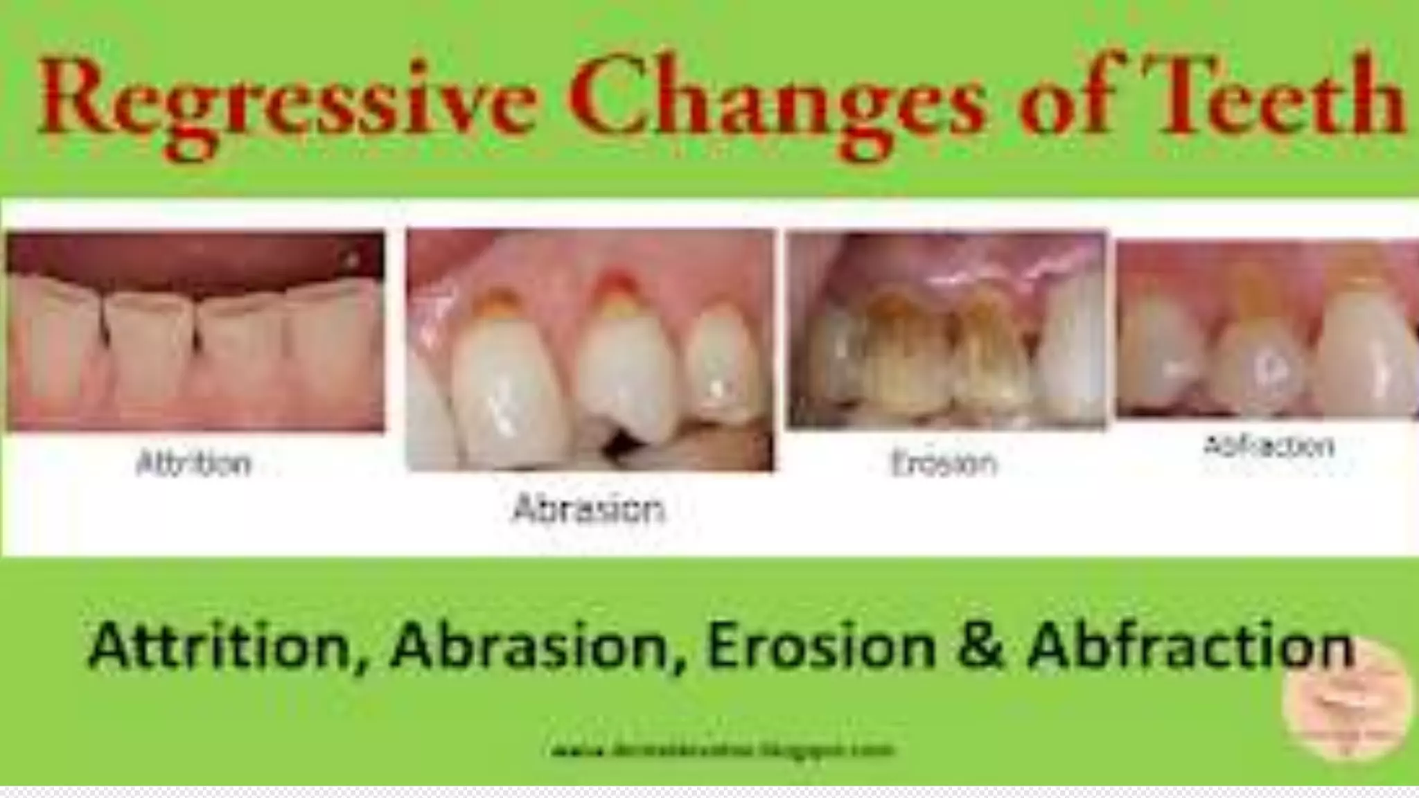 ATTRITION OF TEETH (Regressive Alterations of Teeth) | PPTX