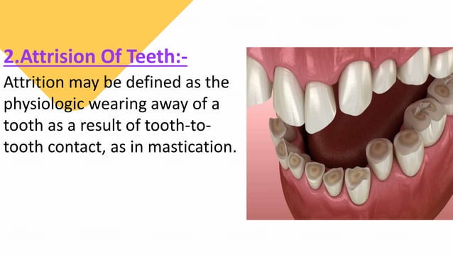 ATTRITION OF TEETH (Regressive Alterations of Teeth) | PPTX | Dental ...