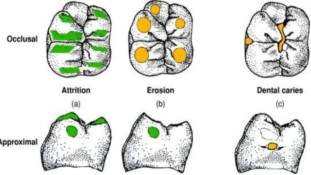 ATTRITION OF TEETH (Regressive Alterations of Teeth) | PPTX | Dental ...