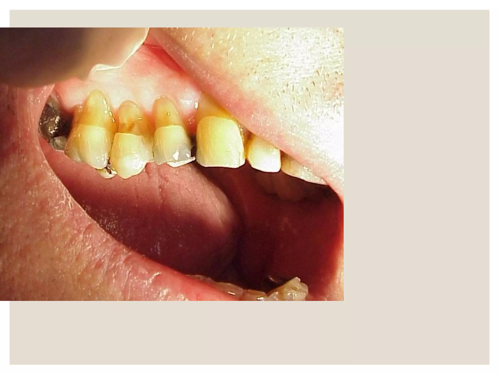 Regressive alterations of teeth | PPT