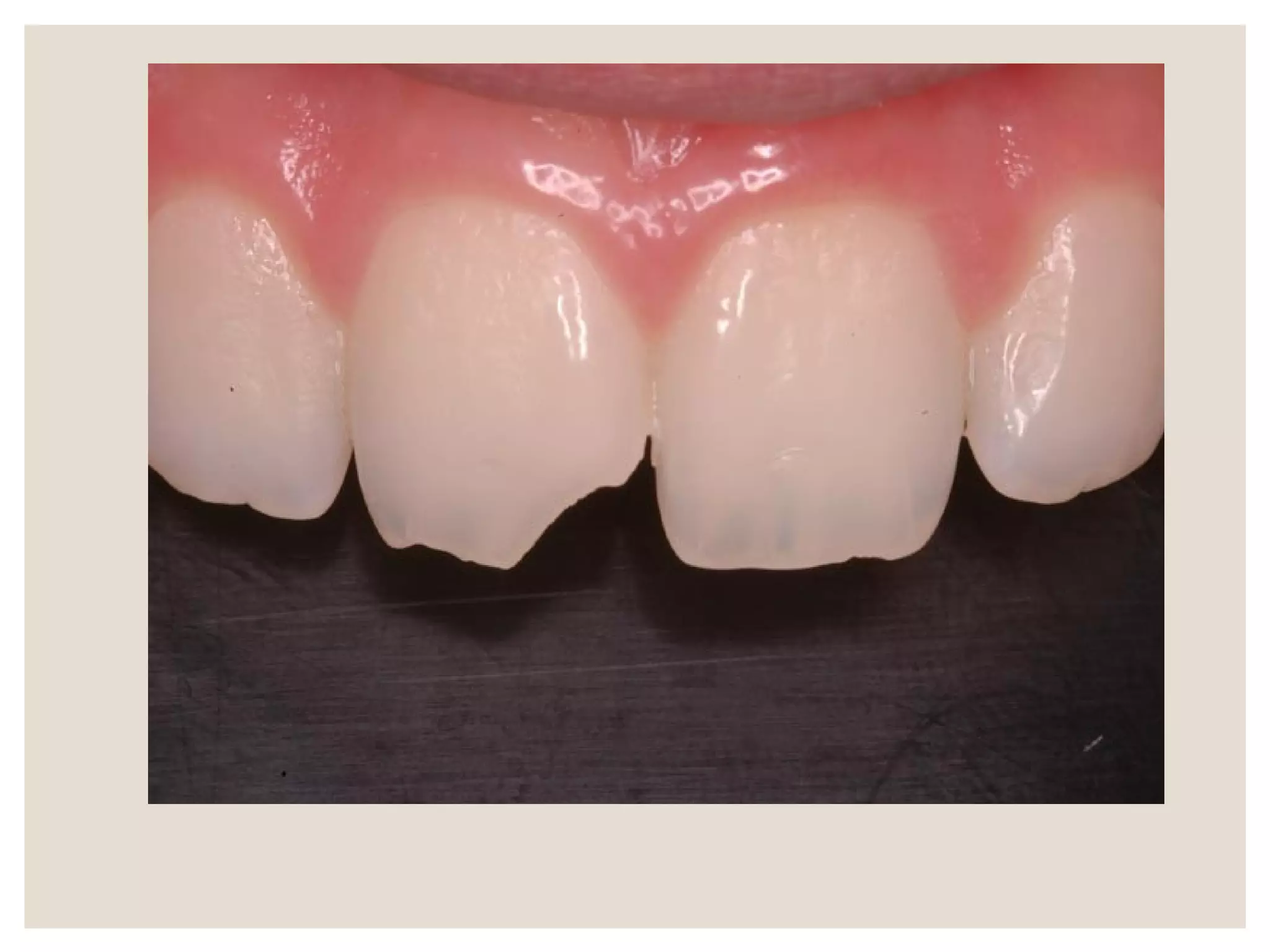 Regressive alterations of teeth | PPT