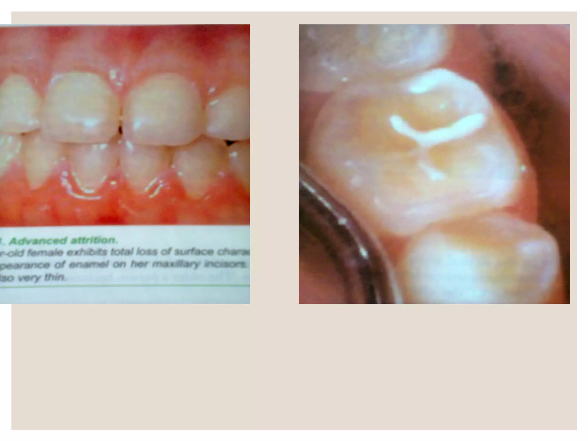 Regressive alterations of teeth | PPT