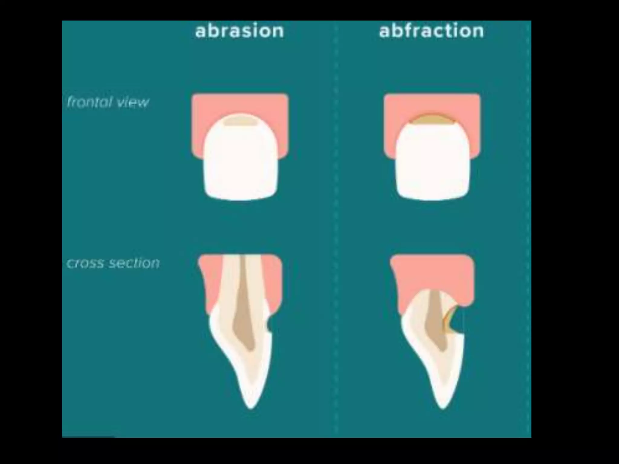 Regressive alterations of teeth | PPTX