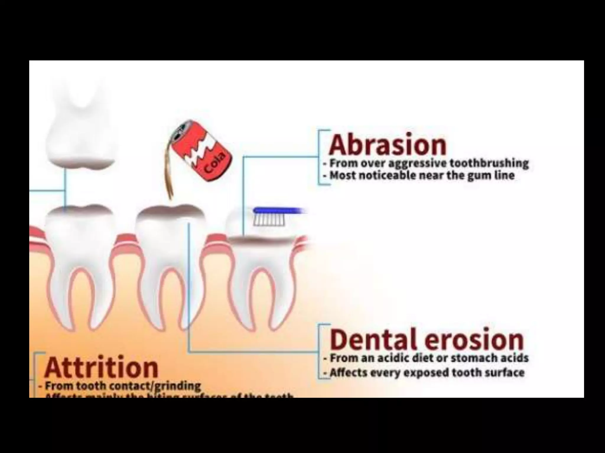 Regressive alterations of teeth | PPTX