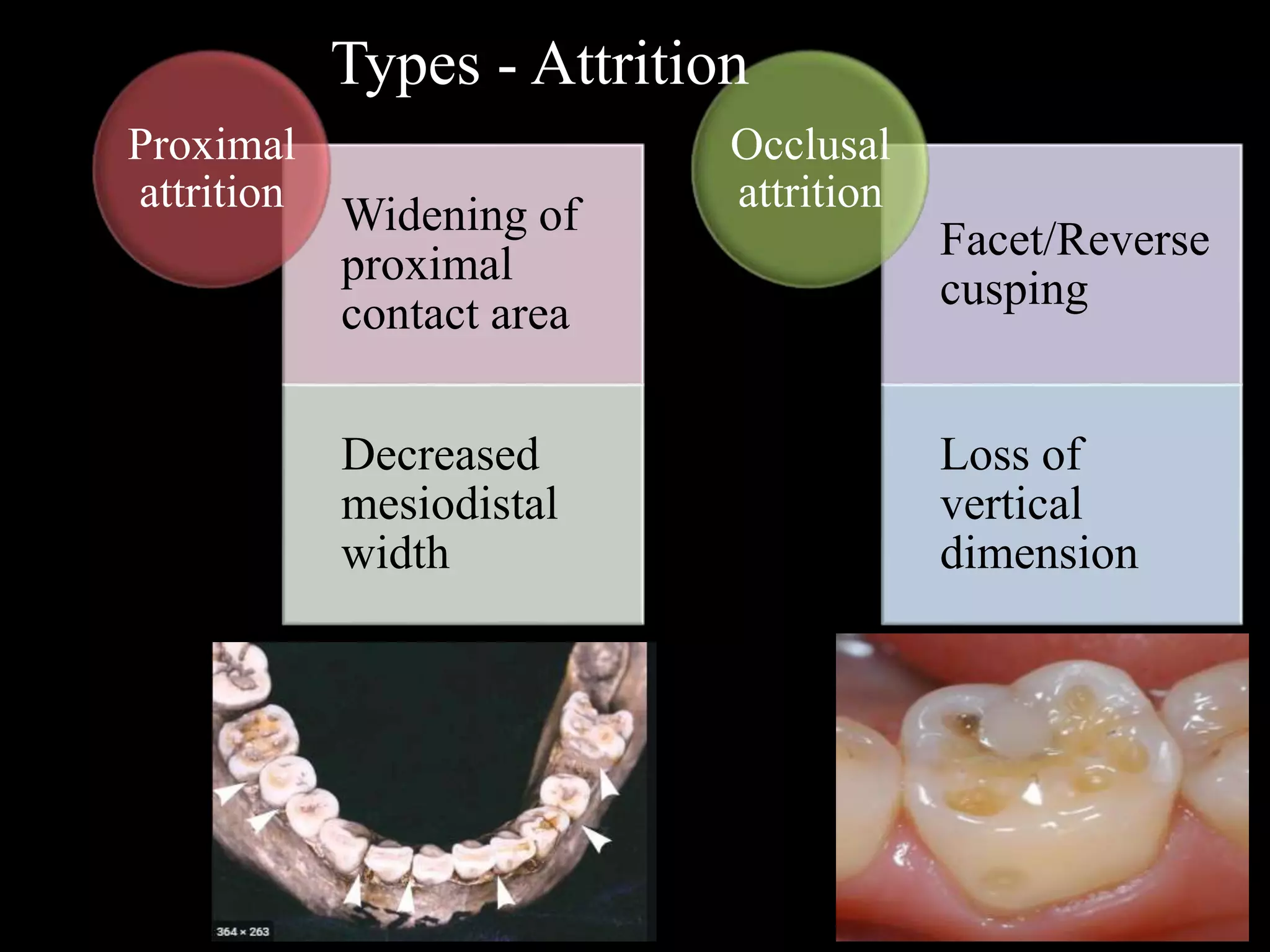 Regressive alterations of teeth | PPTX