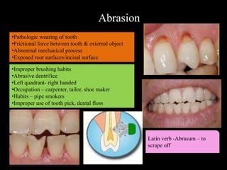 Regressive alterations of teeth | PPTX