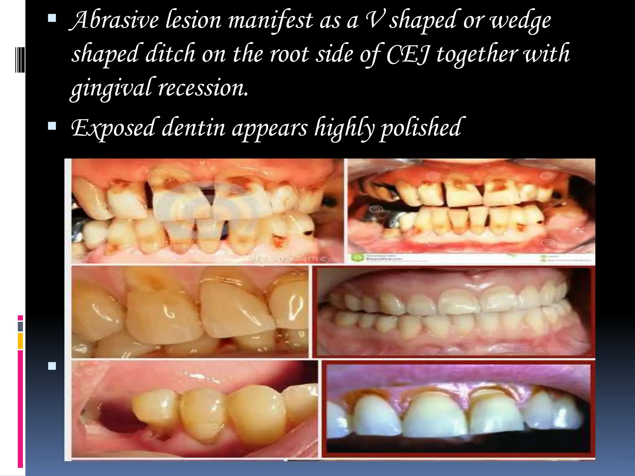 REGRESSIVE ALTERATIONS OF THE TEETH.pptx