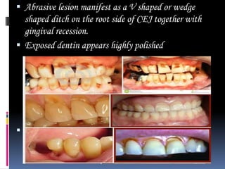 REGRESSIVE ALTERATIONS OF THE TEETH.pptx