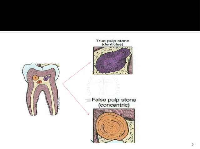 Regressive alterations pulp stones ppt..pptx