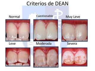 Indices epidemiologicos (Odontologia) | PPTX