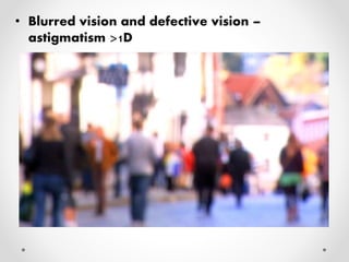 Regular astigmatism by Dr.vinay gadiputi | PPTX