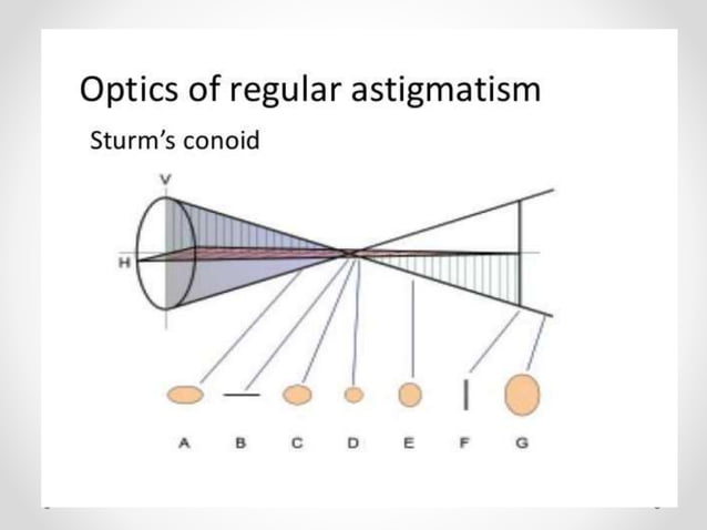 Regular astigmatism by Dr.vinay gadiputi | PPTX | Eye and Vision Conditions | Diseases and ...
