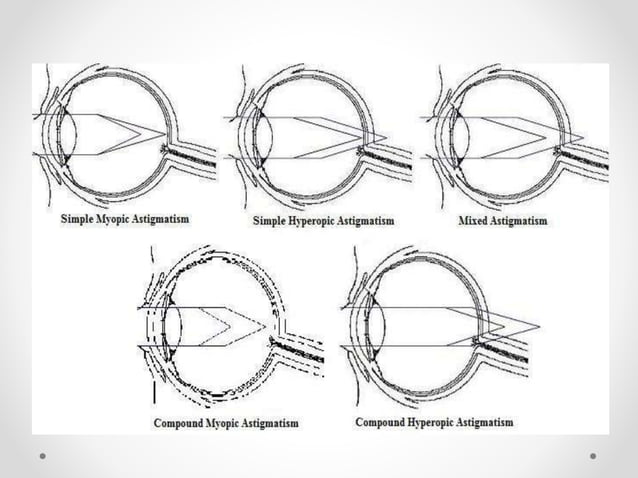 Regular astigmatism by Dr.vinay gadiputi | PPTX | Eye and Vision ...