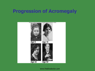 Acromegaly Progression