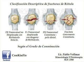 Rehabilitación en las distintas Fracturas de Rótula.PDF