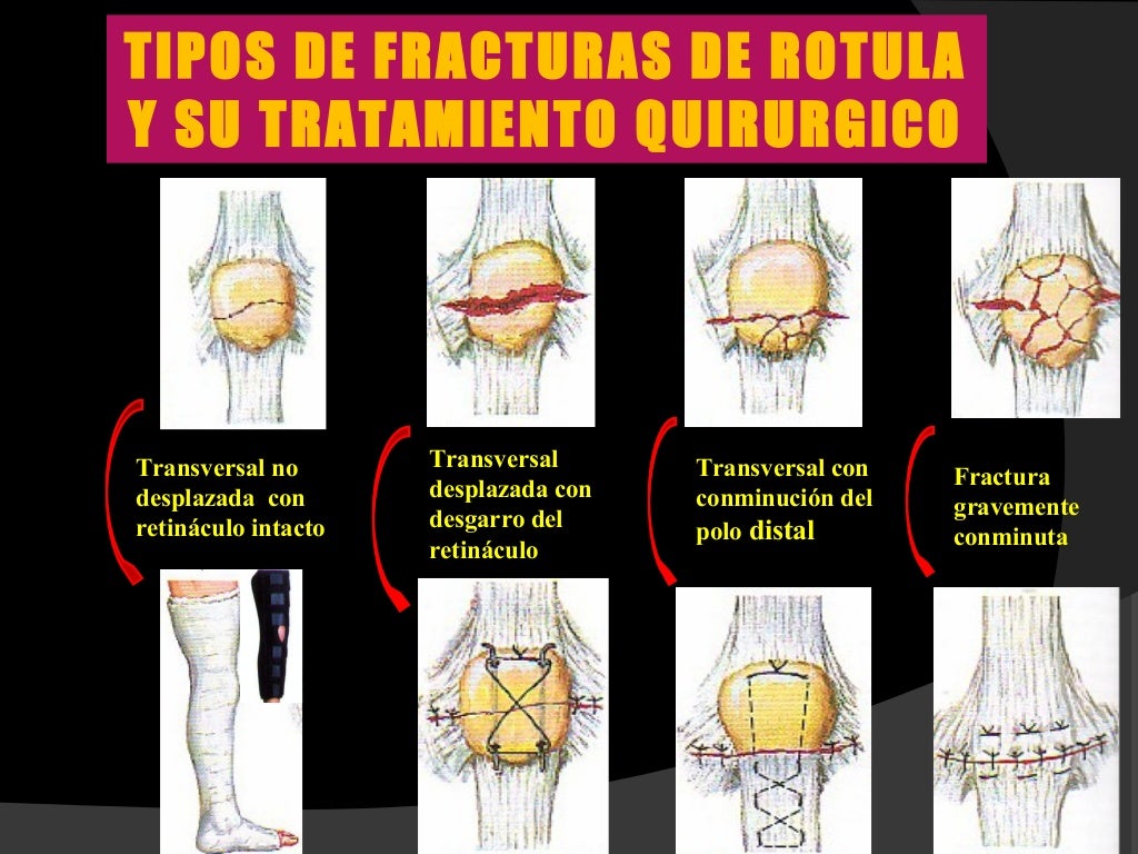 Rehabilitacion en fracturas de rotula
