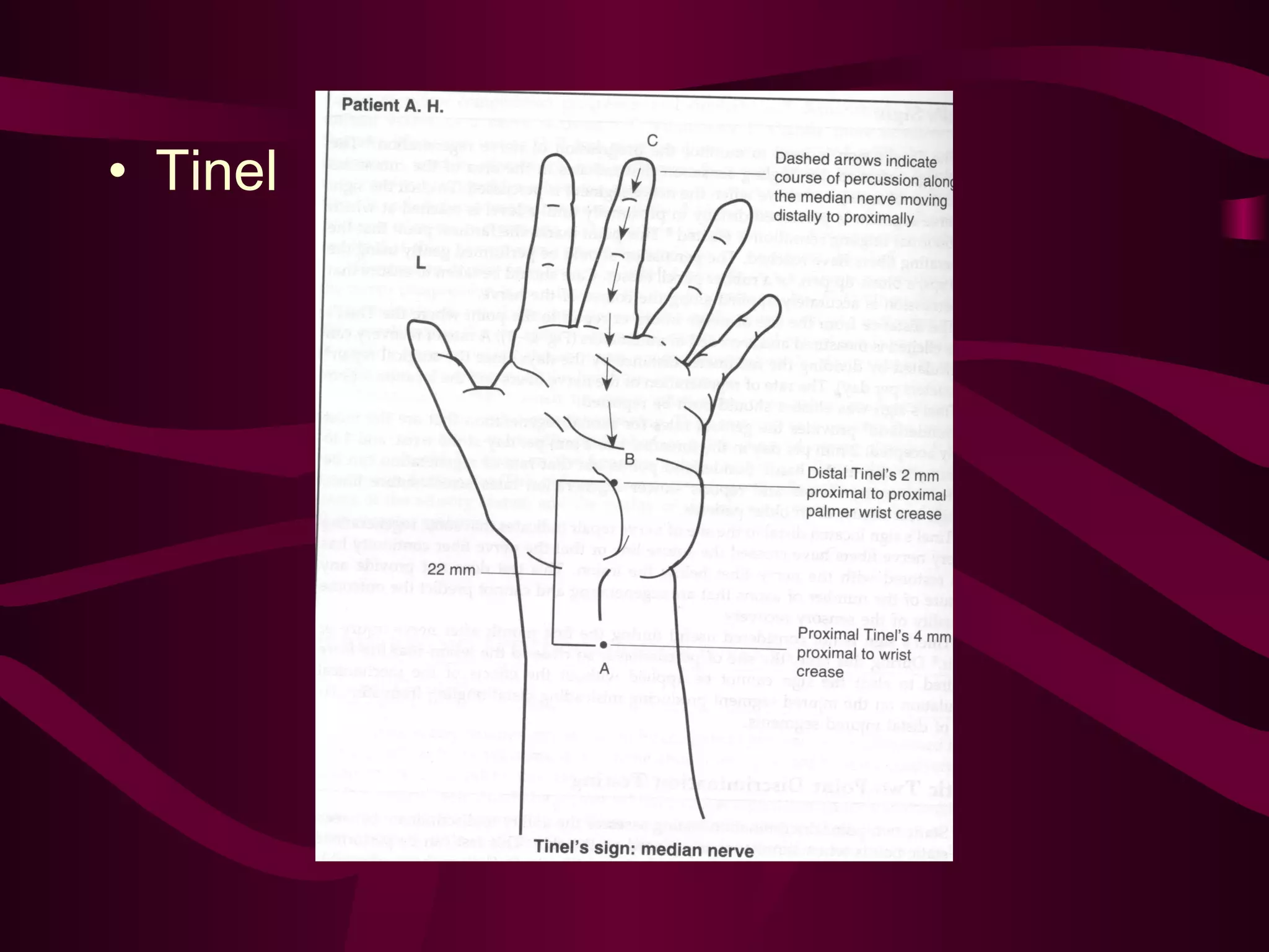 Hand Therapist: Rehabilitation of Fingertip Injuries | PPT
