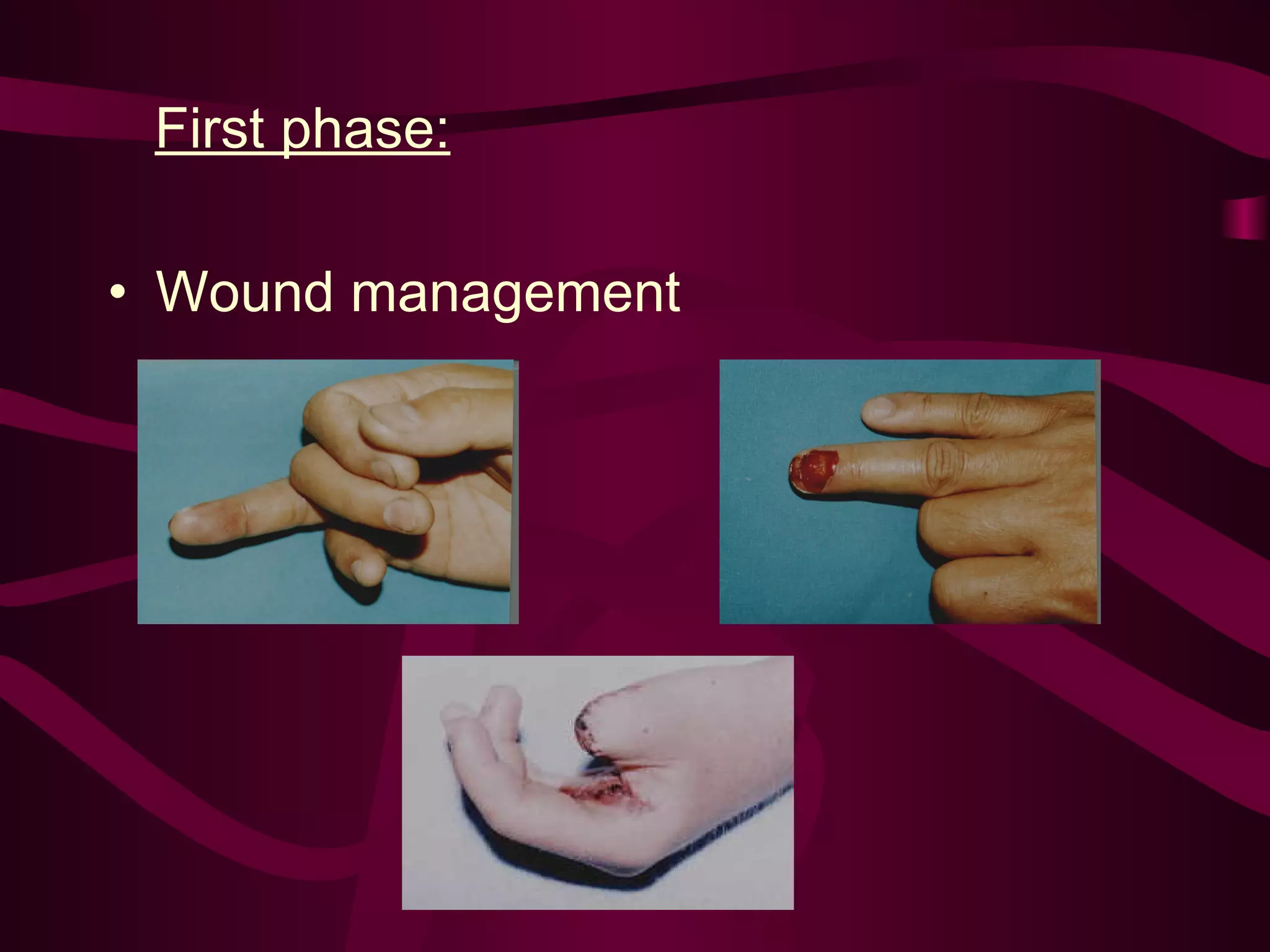 Hand Therapist: Rehabilitation of Fingertip Injuries | PPT