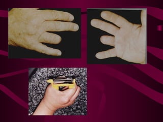 Hand Therapist: Rehabilitation of Fingertip Injuries | PPT
