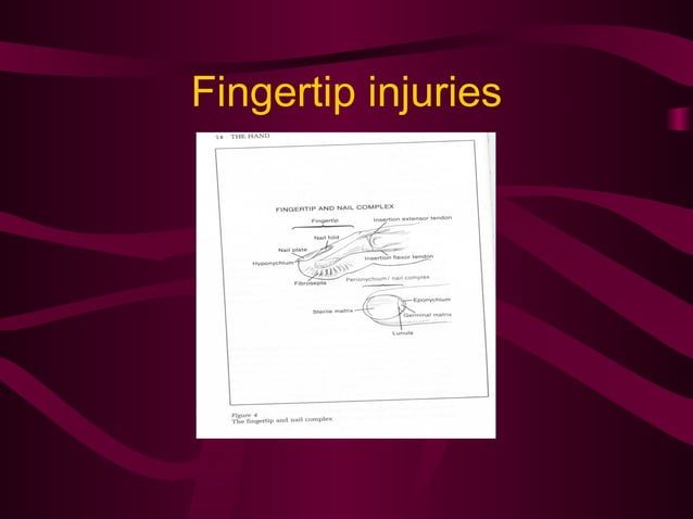 Hand Therapist: Rehabilitation of Fingertip Injuries | PPT
