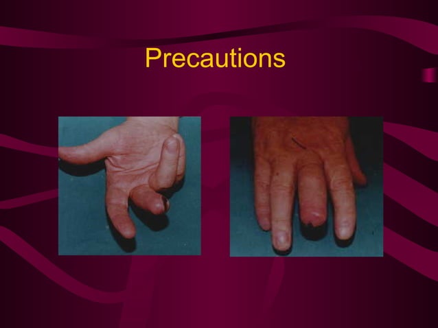 Hand Therapist: Rehabilitation of Fingertip Injuries | PPT