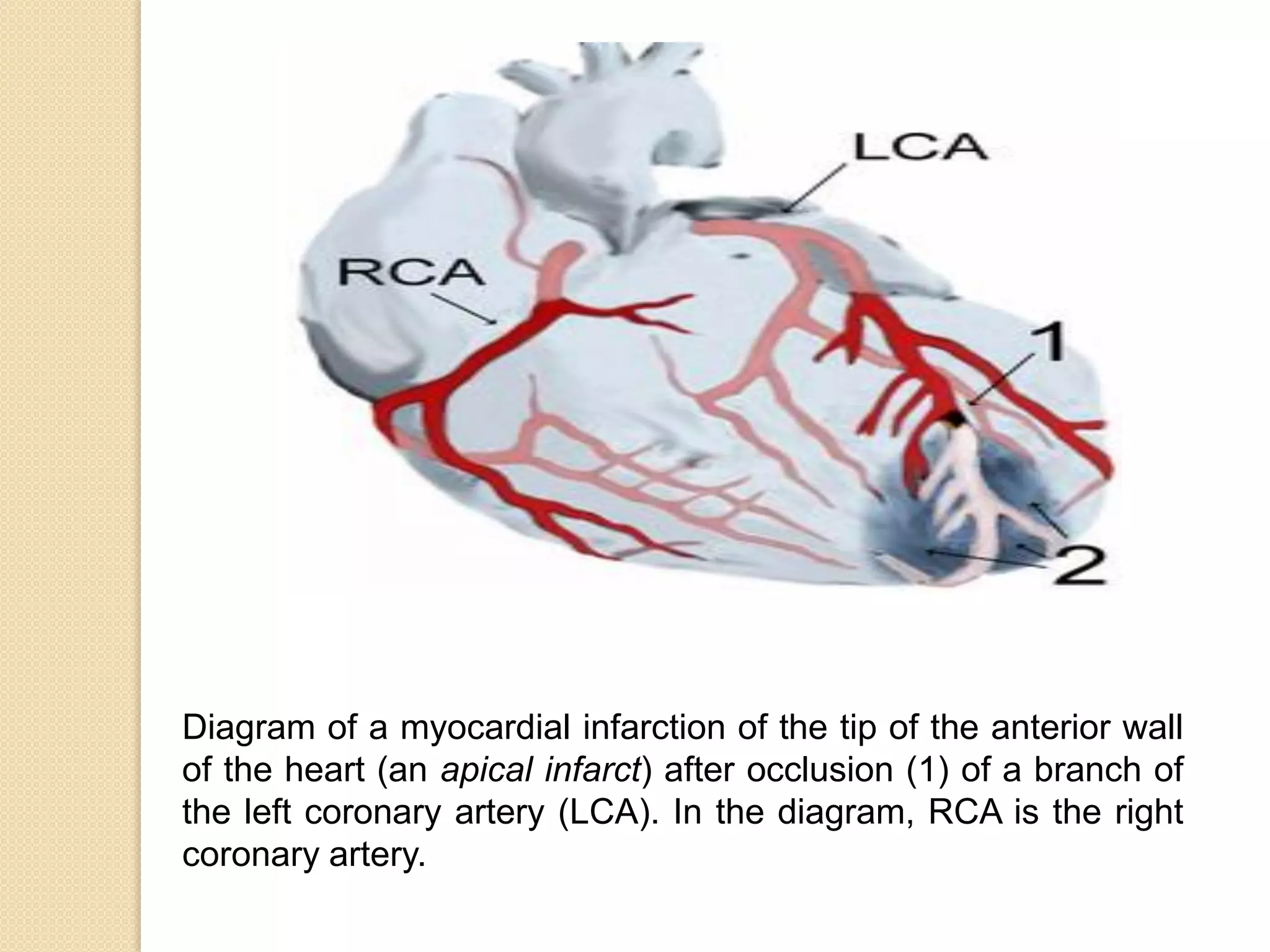 Rehabilitation following Myocardial Infarction | PDF