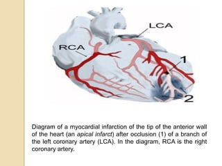 Rehabilitation following Myocardial Infarction | PDF