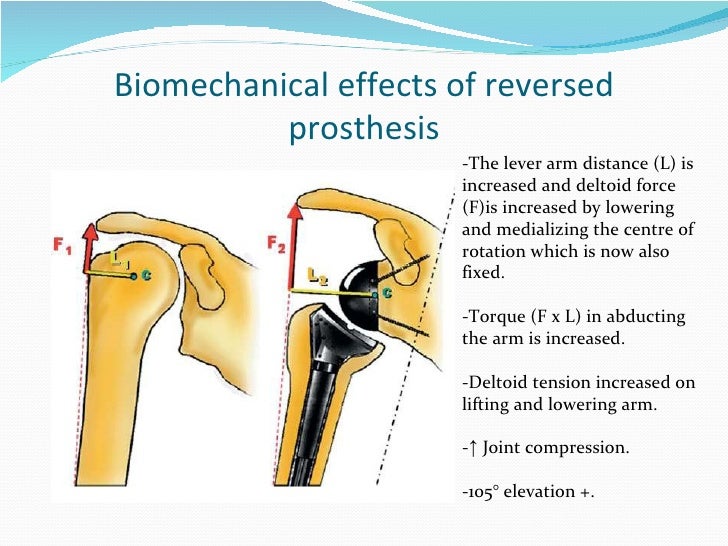 Rehabilitation Following A Reversed Total Shoulder Arthroplasty Nwulg Rehabilitation Following A Reversed Total Shoulder Arthroplasty Nwulg