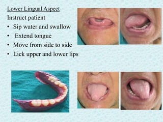 Rehabilitation of a patient with severely resorbed mandibularfinal | PPTX