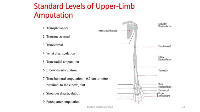 Rehabilitation of dominant upper limb amputation | PPTX