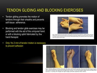 Rehabilitation of hand fractures | PPTX