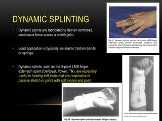 Rehabilitation of hand fractures | PPTX