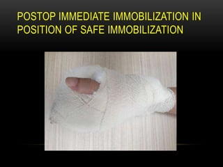 Rehabilitation of hand fractures | PPTX