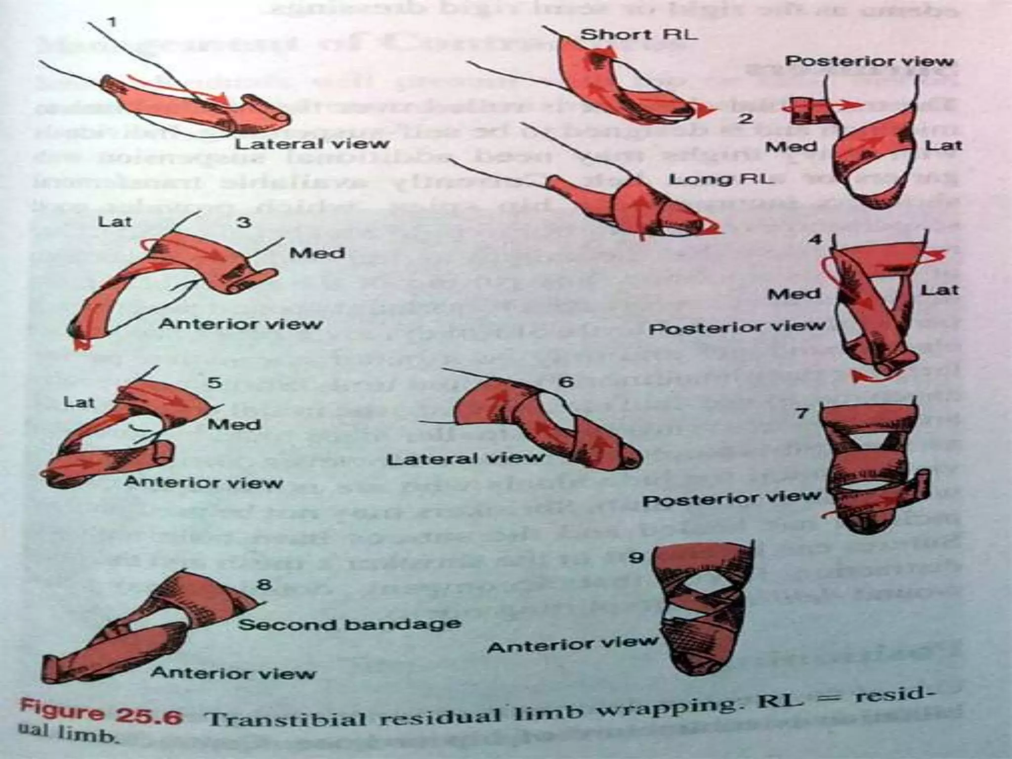 Rehabilitation of lower limb amputee | PPTX