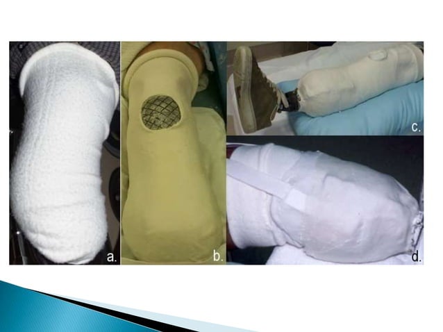 Rehabilitation of lower limb amputee | PPTX | Injuries | Diseases and ...