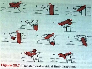 Rehabilitation of lower limb amputee | PPTX