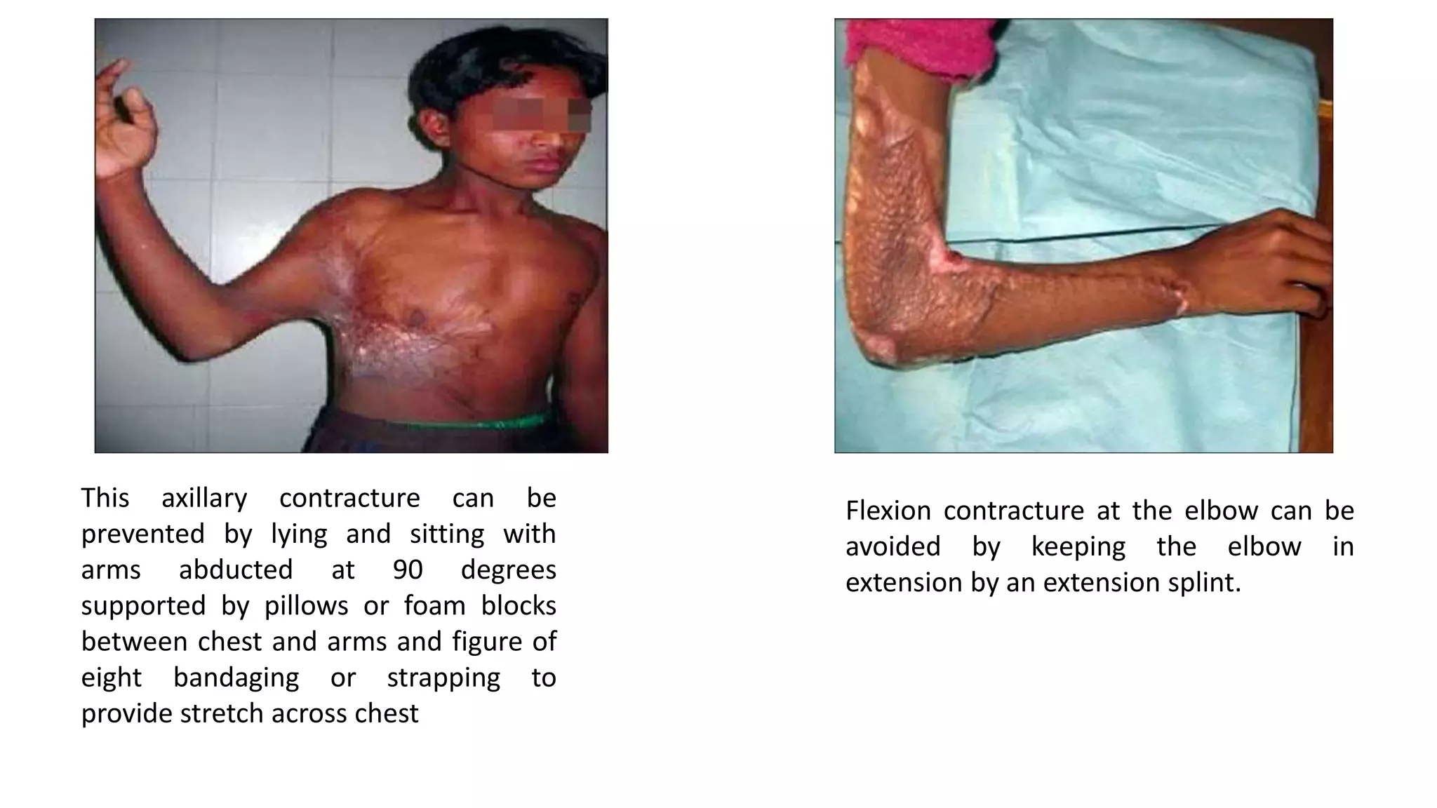REHABILITATION OF THE BURN PATIENT by Neenu.pptx