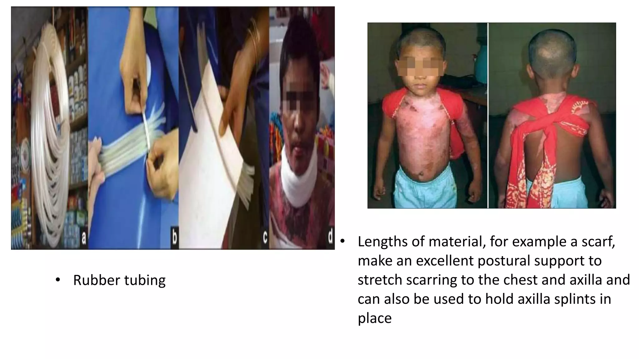 REHABILITATION OF THE BURN PATIENT by Neenu.pptx | First Aid | Injuries