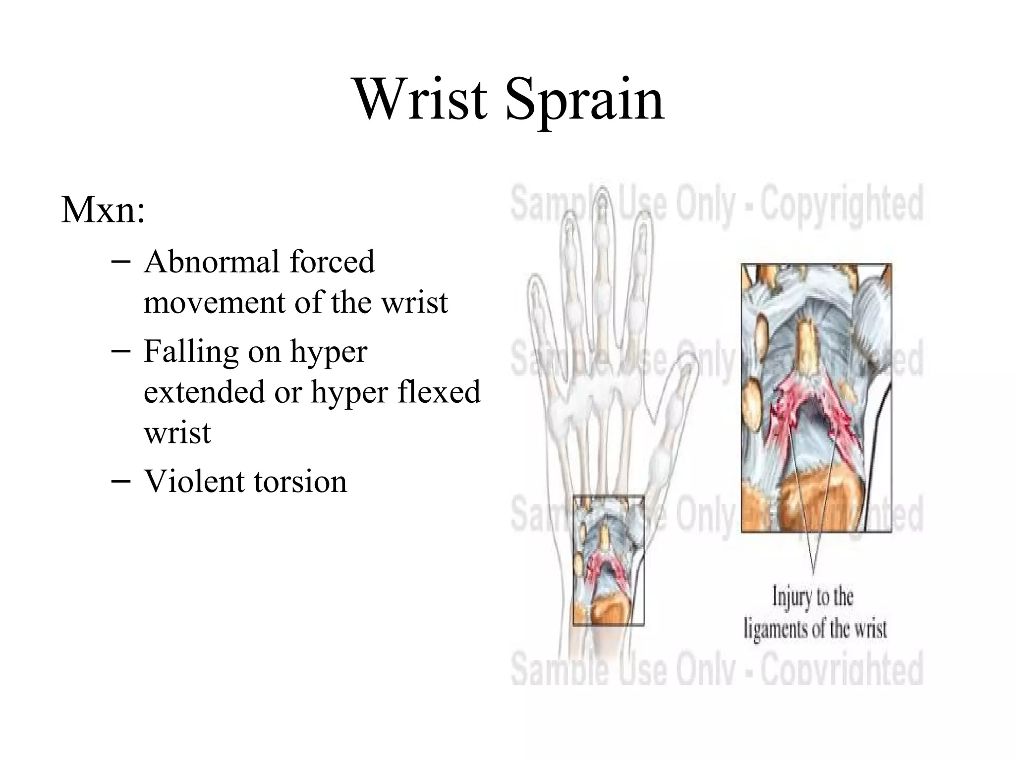 Rehab of injuries to the wrist and hand power pt | PPT