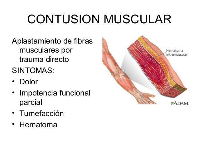 HEMATOMA O CONTUSIÓN MUSCULAR ~ terapia física