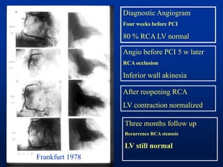 CTO PCI – How it all started in Europe | PPTX | Heart and ...