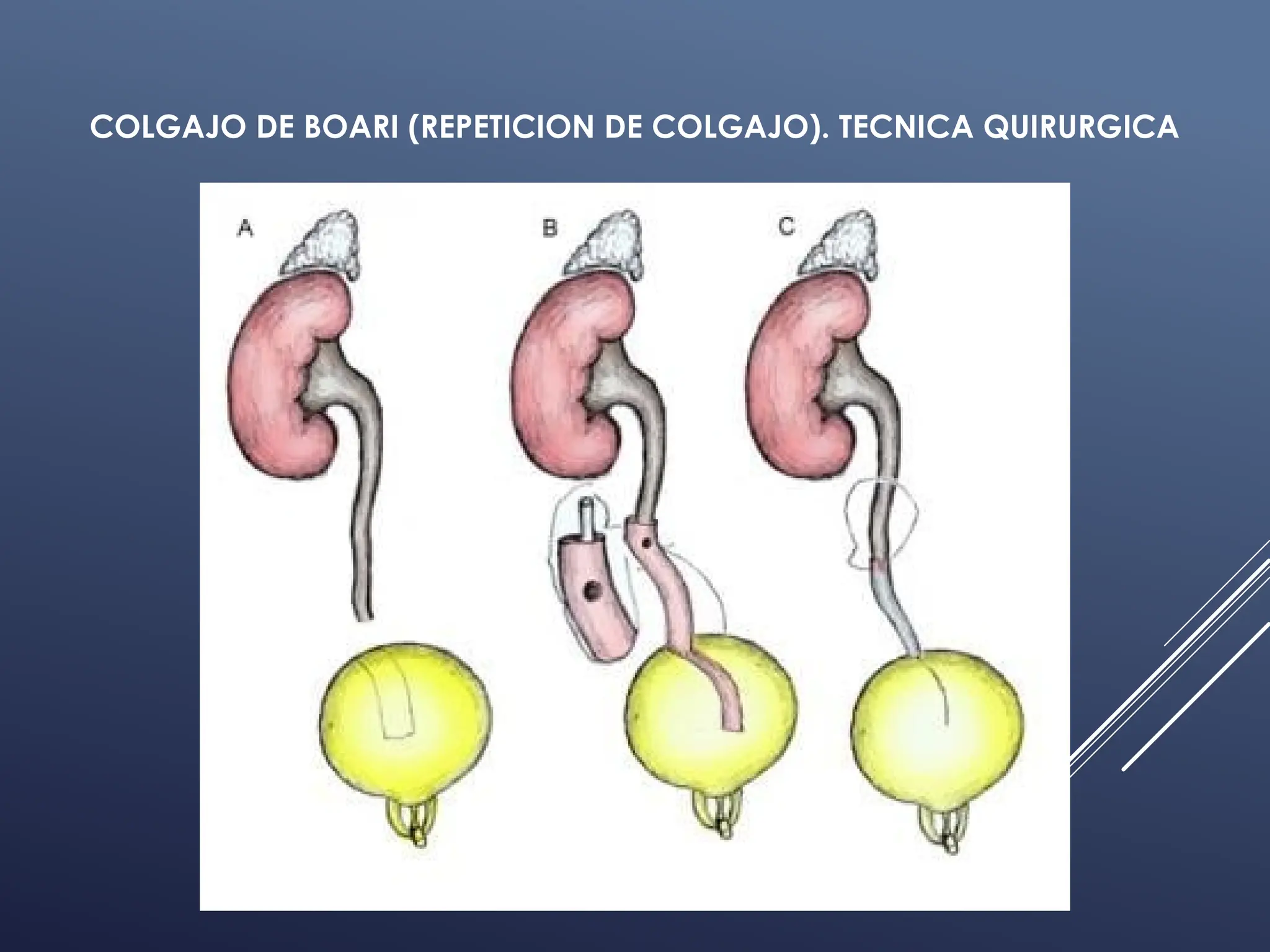 REIMPLANTE URETERAL TECNICAS QX2023.pptx