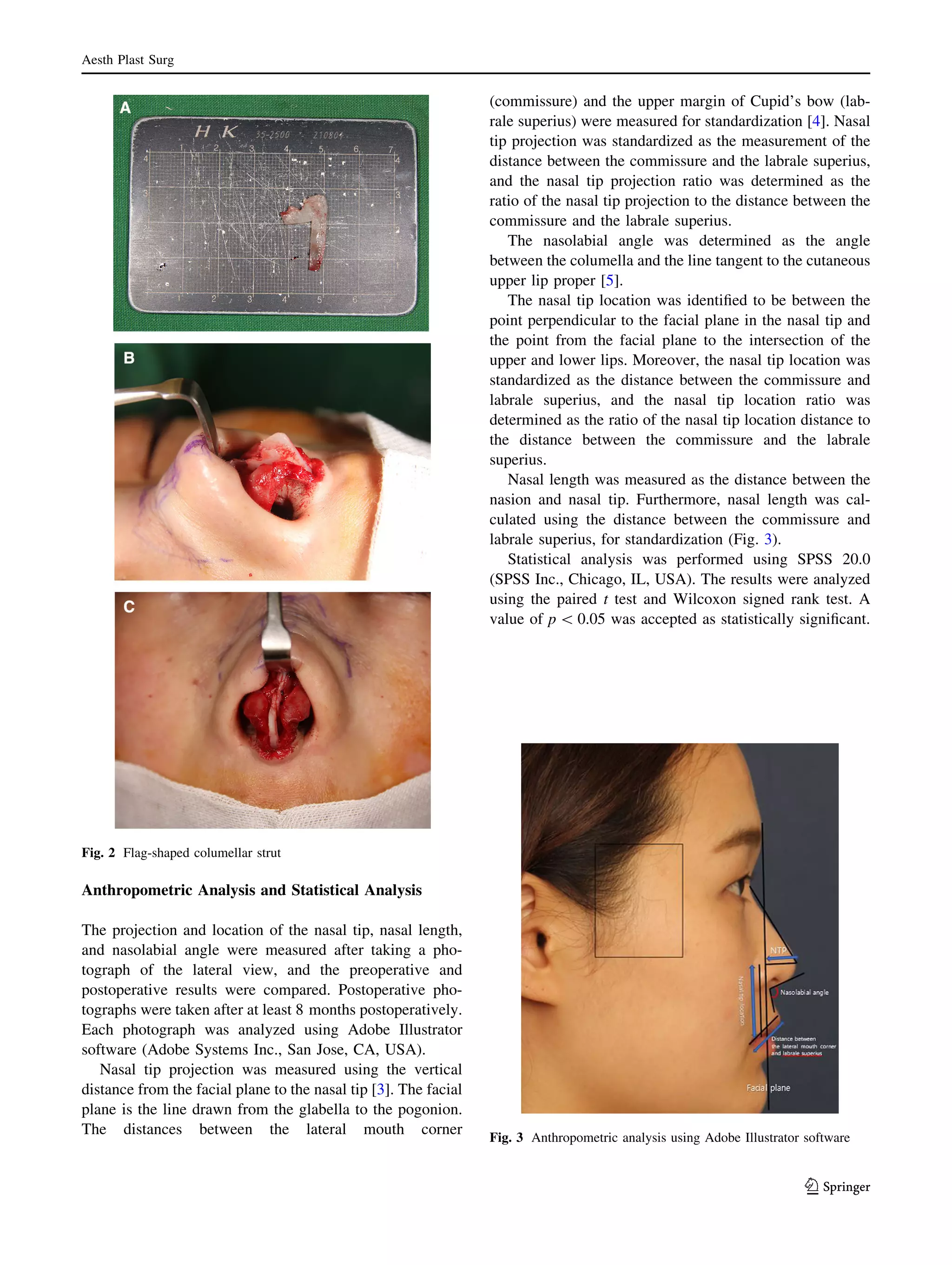 A Novel Technique of Asian Tip Plasty by Dr. Man Koon, Suh from JW Plastic Surgery | PDF
