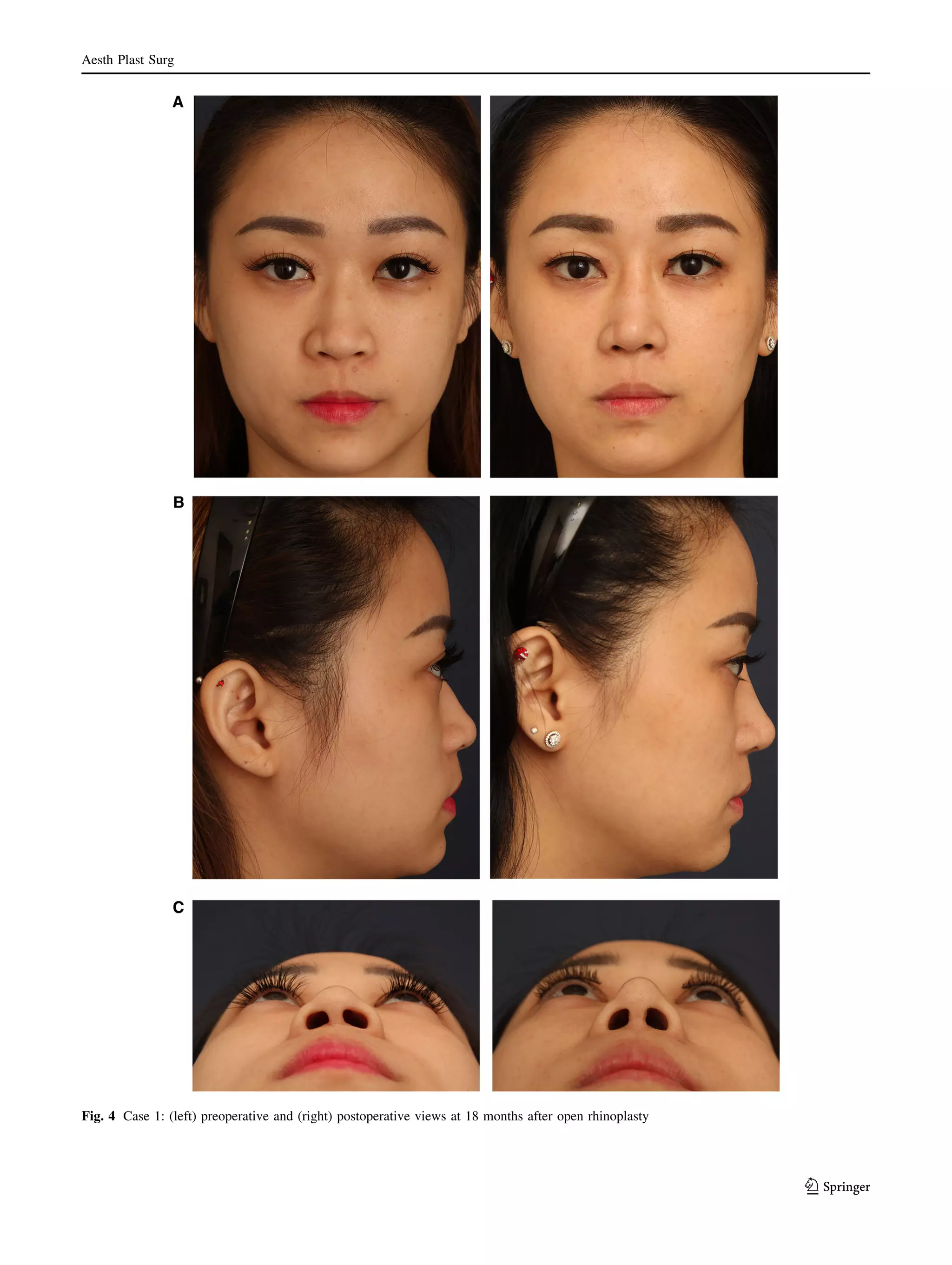 A Novel Technique of Asian Tip Plasty by Dr. Man Koon, Suh from JW Plastic Surgery | PDF