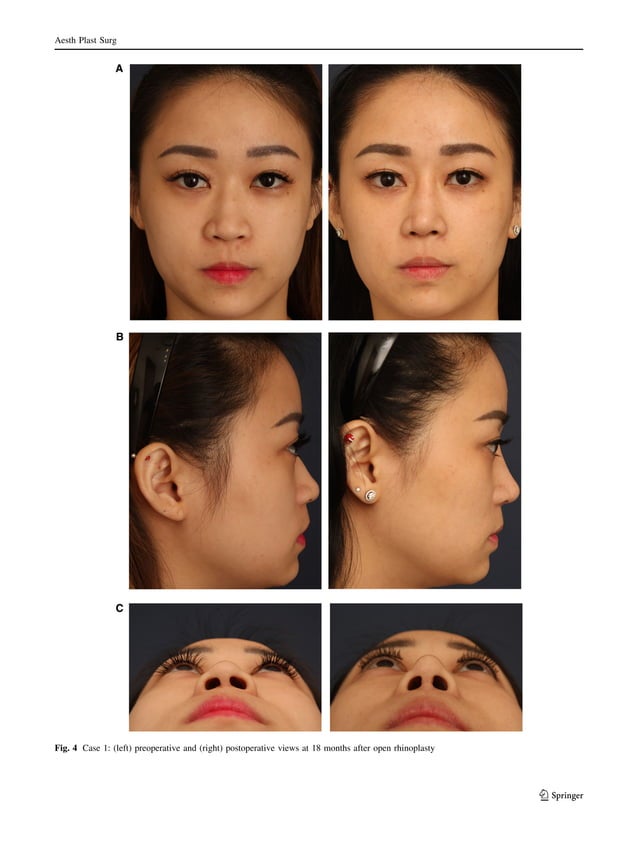 A Novel Technique of Asian Tip Plasty by Dr. Man Koon, Suh from JW ...
