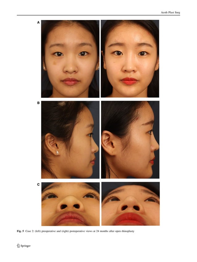 A Novel Technique of Asian Tip Plasty by Dr. Man Koon, Suh from JW Plastic Surgery | PDF