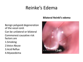 Reinke's oedema | PPTX