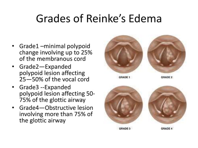 Reinke's oedema | PPTX