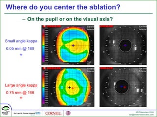Centration of Hyperopic Corneal Ablations: Corneal Vertex vs. Pupil ...