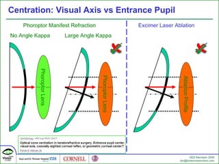 Centration of Hyperopic Corneal Ablations: Corneal Vertex vs. Pupil ...